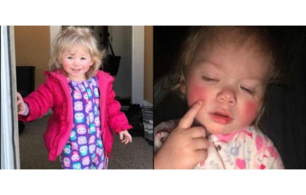 Ivy Angerman, la niña alérgica al agua