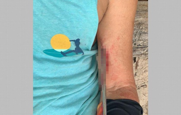 Doloroso, Se clavó un arpón