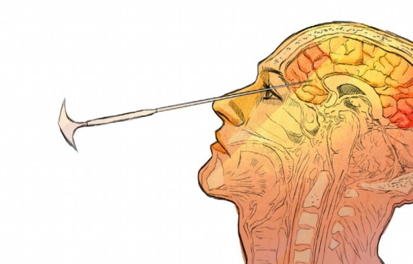 La infame lobotomía, ¿cura o tortura para los pacientes?