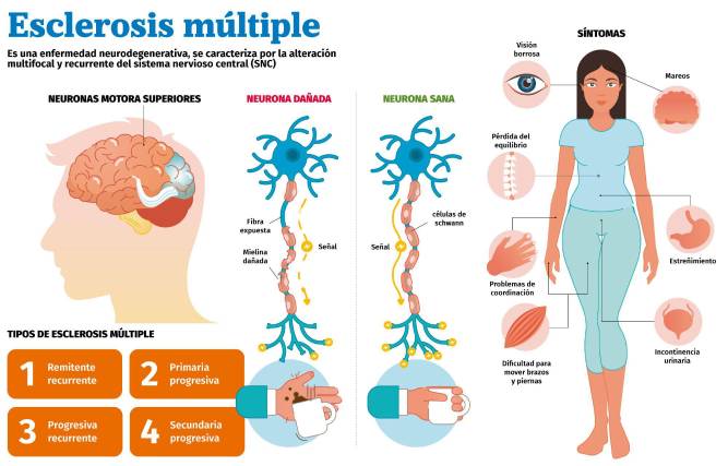 (Video) Esclerosis múltiple: Cuando tus defensas se convierten en tu ...